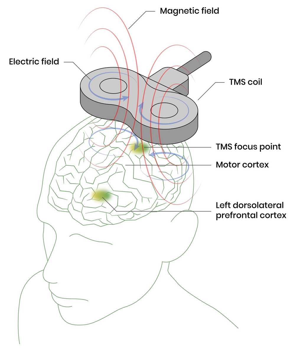 TMS | Magwise Medical Center